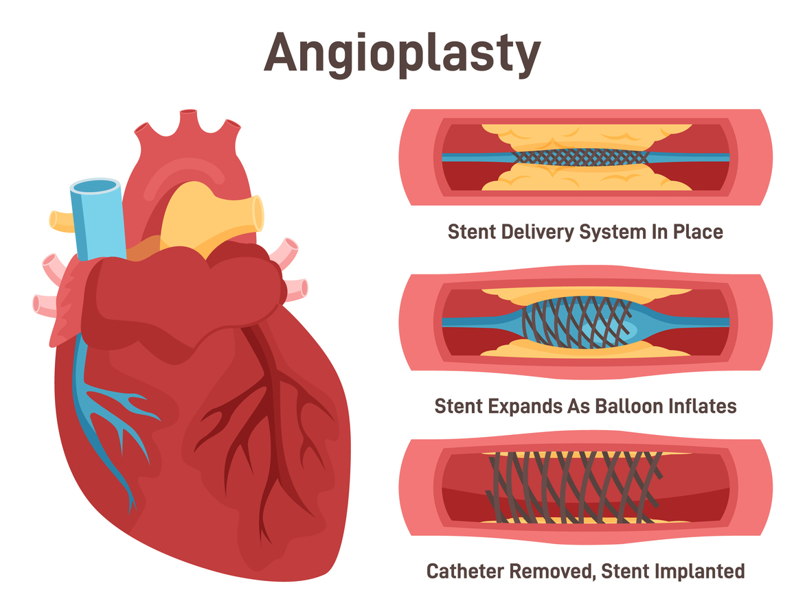 Benefit Of Coronary Angioplasty and Stenting Treatment